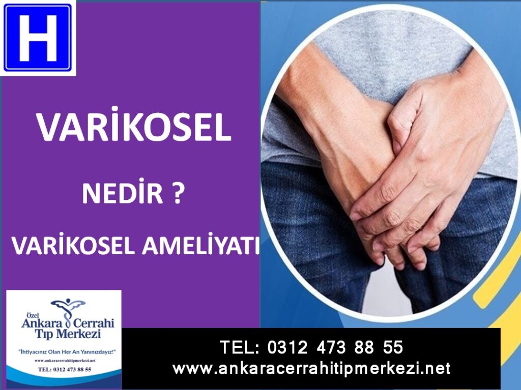 Varikosel Nedir ? Varikosel Tedavisi - Özel Ankara Cerrahi Tıp Merkezi ...